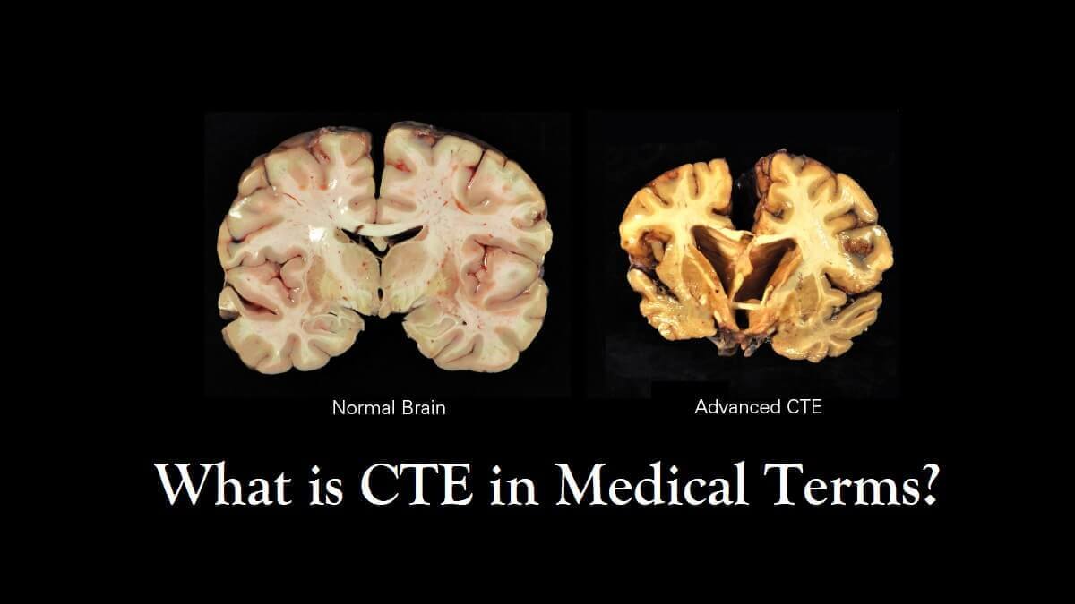 What Is CTE In Medical Terms Definition 13 Symptoms Causes Risk