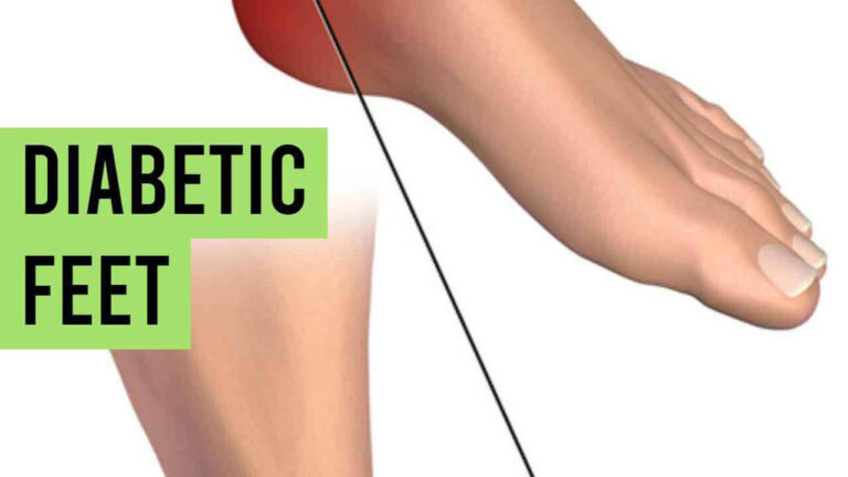 Diabetic Feet: Causes, 11 Symptoms, Complications, And Prevention ...