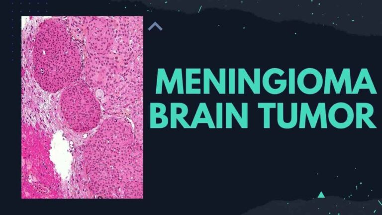 Meningioma Brain Tumor: Causes, Symptoms, Diagnosis, Stages, Treatment ...