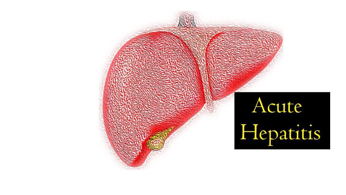 What Is Acute Hepatitis: Causes, Risk Factors, Symptoms, Diagnosis, And ...