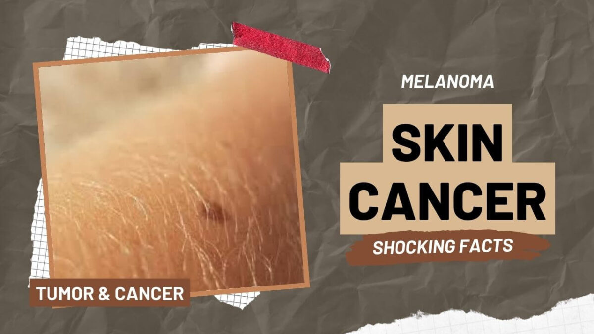 4 Shocking Facts About Skin Cancer Melanoma That Everyone Should Know ...